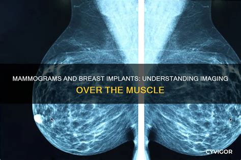 Mammograms And Breast Implants Understanding Imaging Over The Muscle