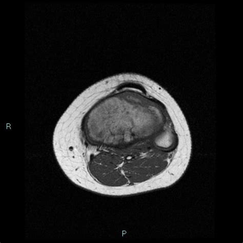 Radiopaedia Case Fibrous Cortical Defect Id 42462 Study 45585 Nc
