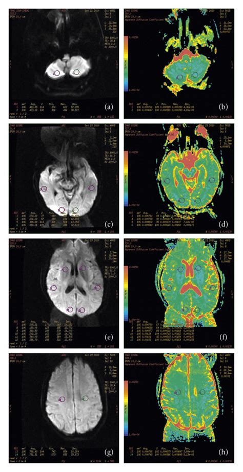 Diffusion Weighted Imaging Of Each Plane Of The Brain Before Surgery