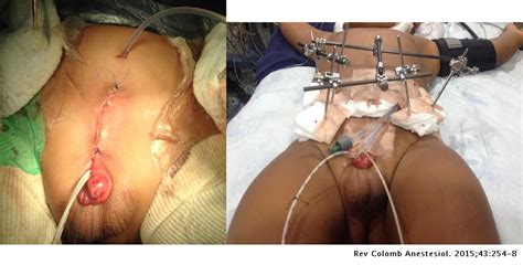 Anaesthesia And Analgesia For Bladder Exstrophy Correction Case Reports Colombian Journal Of