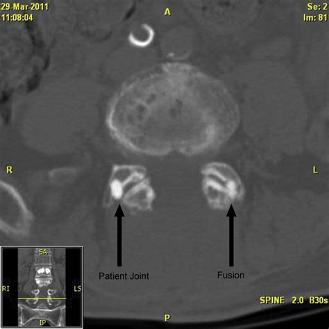 Radiographic Fusion Rate After Implantation Of Facet Bone Dowels The
