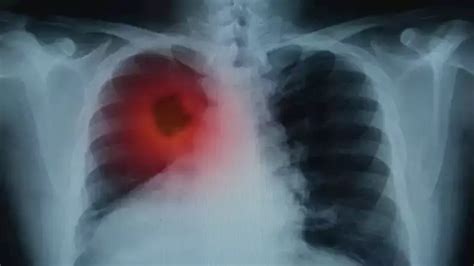 اختبار بول بسيط يكشف سرطان الرئة في مراحله المبكرة تعرف عليه