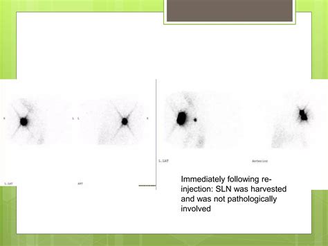 Sentinel Node Mapping In Breast Cancer Controversies PPTX Skin And Dermatology Diseases