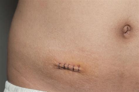 Appendix Removal Surgery