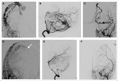 Cerebral DSA Of The 3 Patients Presented In Figure 2 Cases 4 15 And Download Scientific