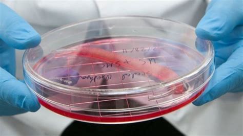 3d Bioprinting Makes Progress As Lab Grown Bladder Helps Young Man To Lead A Normal Life