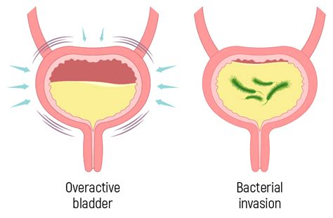 Cystitis And Utis Soluro