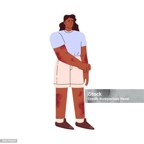 고통 여자 손에 피부를 긁는 피부 문제 알레르기 건선 아토피 성 피부염 벡터 일러스트 레이 션 대상포진에 대한 스톡 벡터 아트 및 기타 이미지 Istock