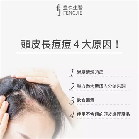 頭皮長痘痘原來也是毛囊炎？專家教你4招恢復清爽的健康頭皮！