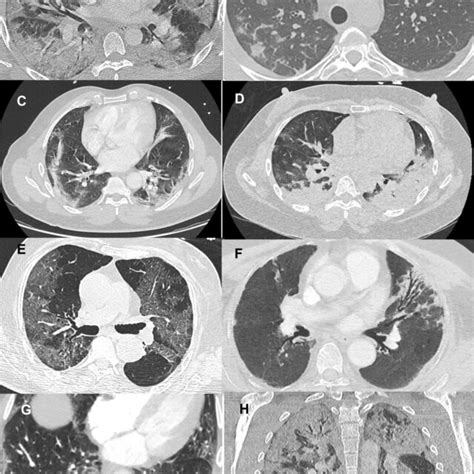 Representative Panels Of Studied Lung Patterns Axial Views Are Shown