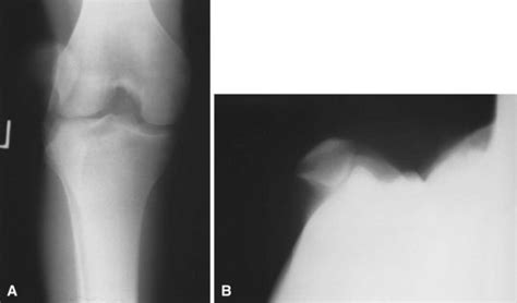 Acute Dislocations Musculoskeletal Key