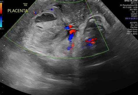 Placental Abruption Sonosession