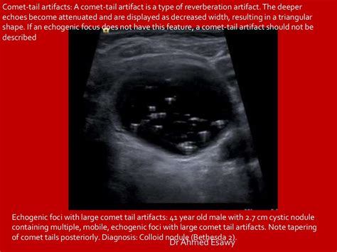 Tirads Thyroid Nodule Imaging Reporting And Data System Dr Ahmed E…