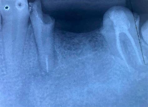 Radiographic Evaluation Iopa Showing Post Space Preparation