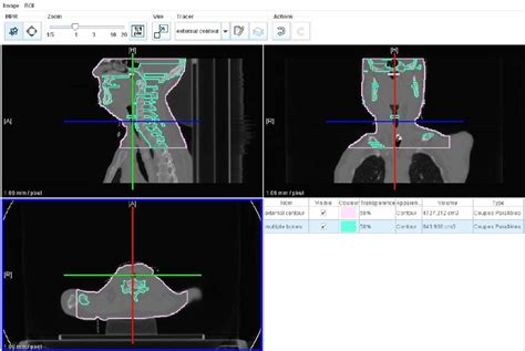 A Screen Shot Showing The Contours Of The External Contour And Bones In