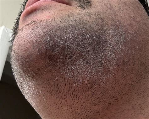 Flaky And Sore Beard What Is This R Dermatologyquestions