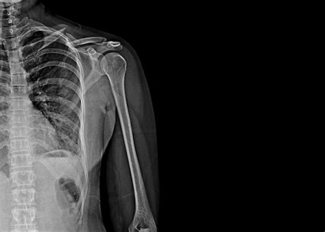 Premium Photo A Person With A Shoulder Joint Has A Dislocation Of The Shoulder