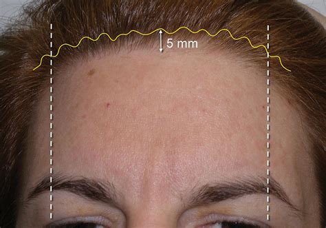 Brow And Forehead Lift Form Function And Evaluation Clinical Tree