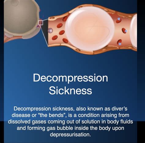 Decompression Sickness The Bends Treatment Pretoria