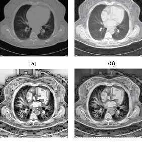 PDF Adaptive Enhancement Of Medical Images