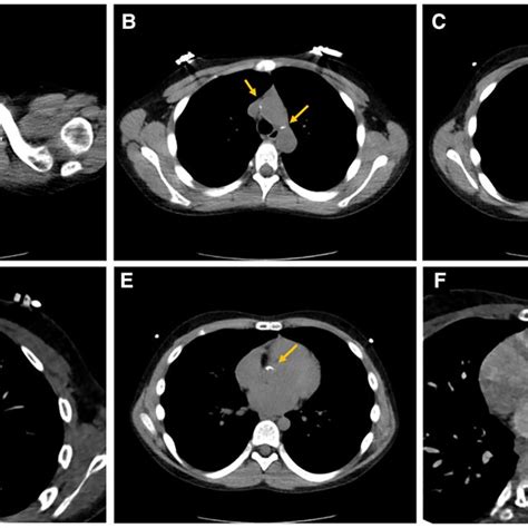 Calcifications Of Multiple Vascular Walls Calcification Foci Of The Download Scientific