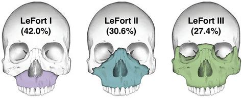 Emergency Facial Injuries In Athletics Clinics In Sports Medicine