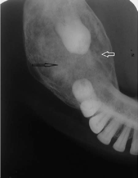 Peripheral Ossifying Fibroma Radiograph