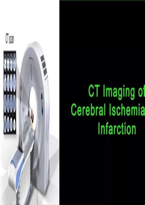 Ct Imaging Of Cerebral Ischemia And Infraction Ct Imaging Of Cerebral Ischemia And Infraction