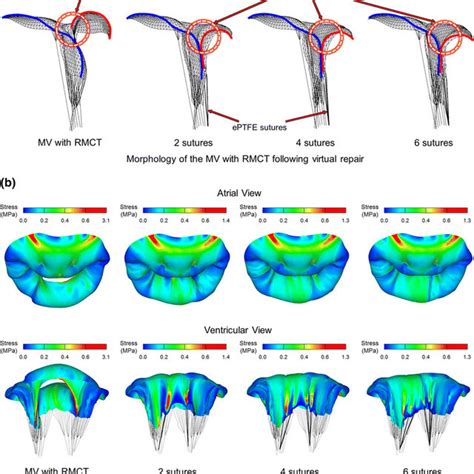 Pdf Mitral Valve Repair Using Eptfe Sutures For Ruptured Mitral Chordae Tendineae A