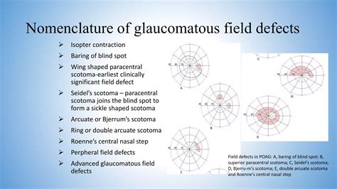Primary Open Angle Glaucoma Pptx