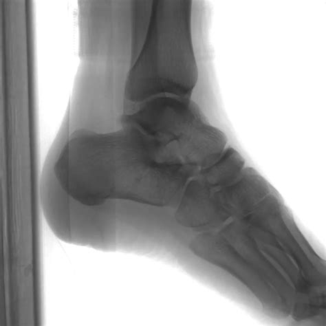 Mobile Radiography System Vs Mobile Surgical C Arm System Perlove