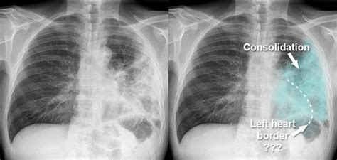 Interstitial Pneumonia X Ray Interstitial Pneumonia X Ray