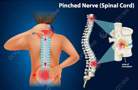 Diagram Showing Pinched Nerve Biology Spinal Cord Back Vector Biology Spinal Cord Back Png