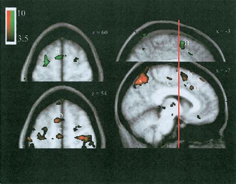 Figure 1 From Role Of The Human Medial Frontal Cortex In Task Switching A Combined Fmri And Tms