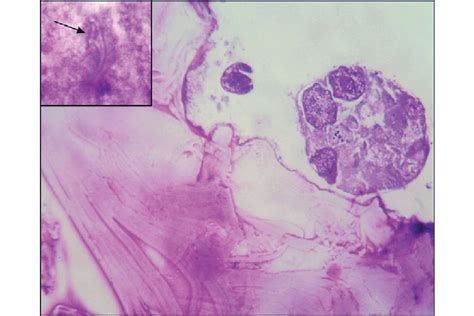 Hydatid Cyst Laminated Membranes With Brood Capsules And Insert Showing Download Scientific