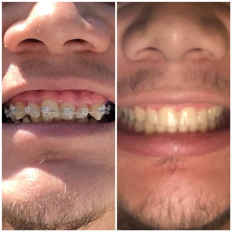 Just Got My Braces Off And Wanted To Share The Before And After