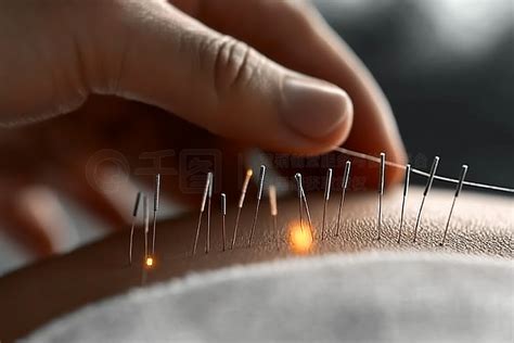 针灸治疗ai数字艺术 针灸治疗中医图片 Ai图片免费下载 Png格式 4032像素 编号71223111 千图网