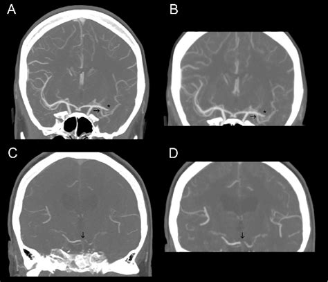 Figure 1 From Angiographic Reconstructions From Whole Brain Perfusion Ct For The Detection Of