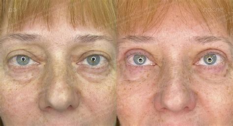 Пластика век от 75 000 рублей Волков Владислав Григорьевич