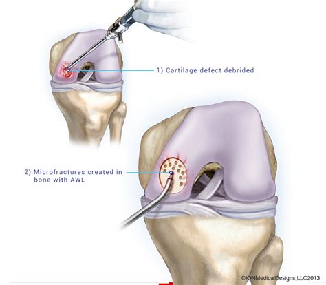 Microfracture Joint Preservation Center