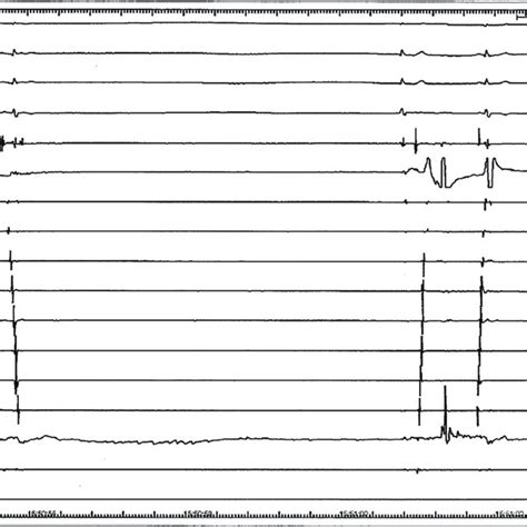 Cessation Of Atrial Flutter After Radiofrequency Ablation And Download Scientific Diagram