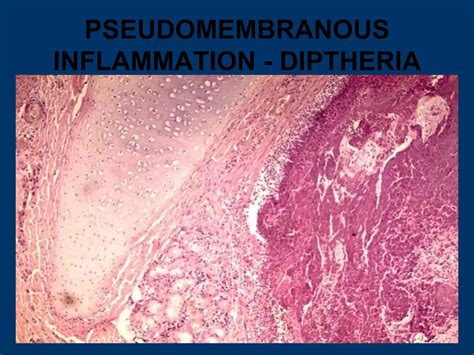 General Pathology Lecture 5 Inflammation And Repair Ppt