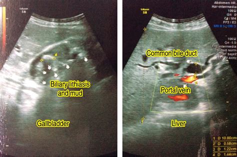Cholangiocarcinoma Diagnostic Approach And A Clinical Case