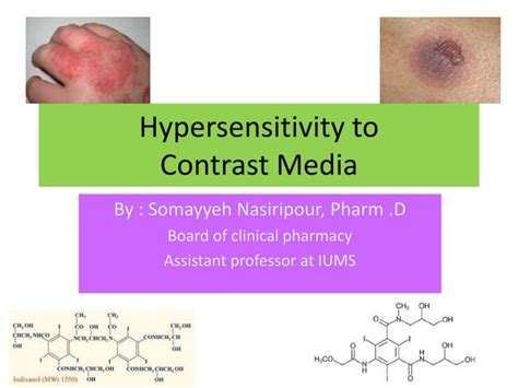 Hypersensitivity To Contrast Media Pptx