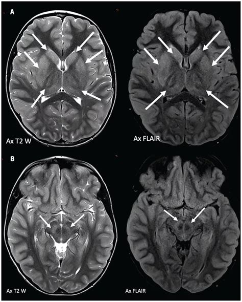 Powassan Virus Understanding The Risks And Symptoms