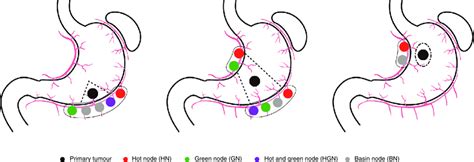 Laparoscopic Sentinel Node Navigation Surgery Involving Sentinel Basin Download Scientific