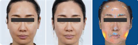 Ultraformer Mpt Facelift Skin Tightening And Body Contouring With The