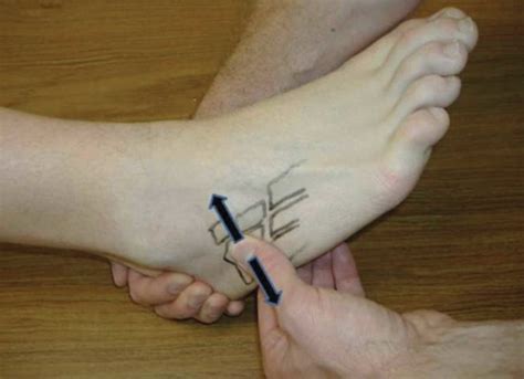 Cuboid Syndrome Causes Symptoms Diagnosis And Treatment