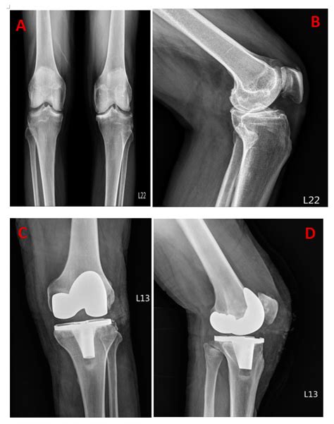 Necrotizing Fasciitis Definition