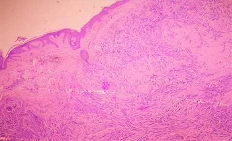 Primary Scalp Tumor Showing Neoplastic Infiltration He 10x Download Scientific Diagram